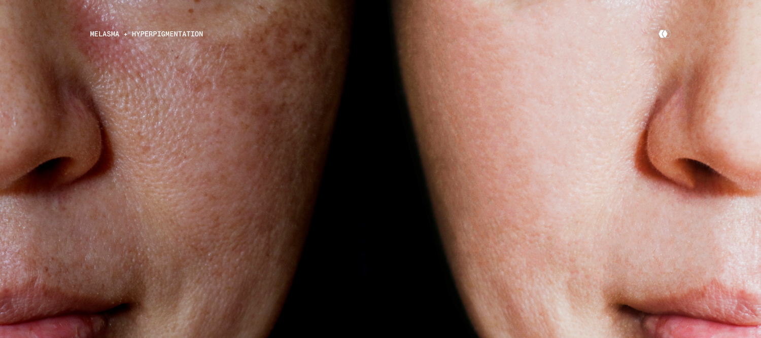 Understanding Melasma and Chronic Hyperpigmentation
